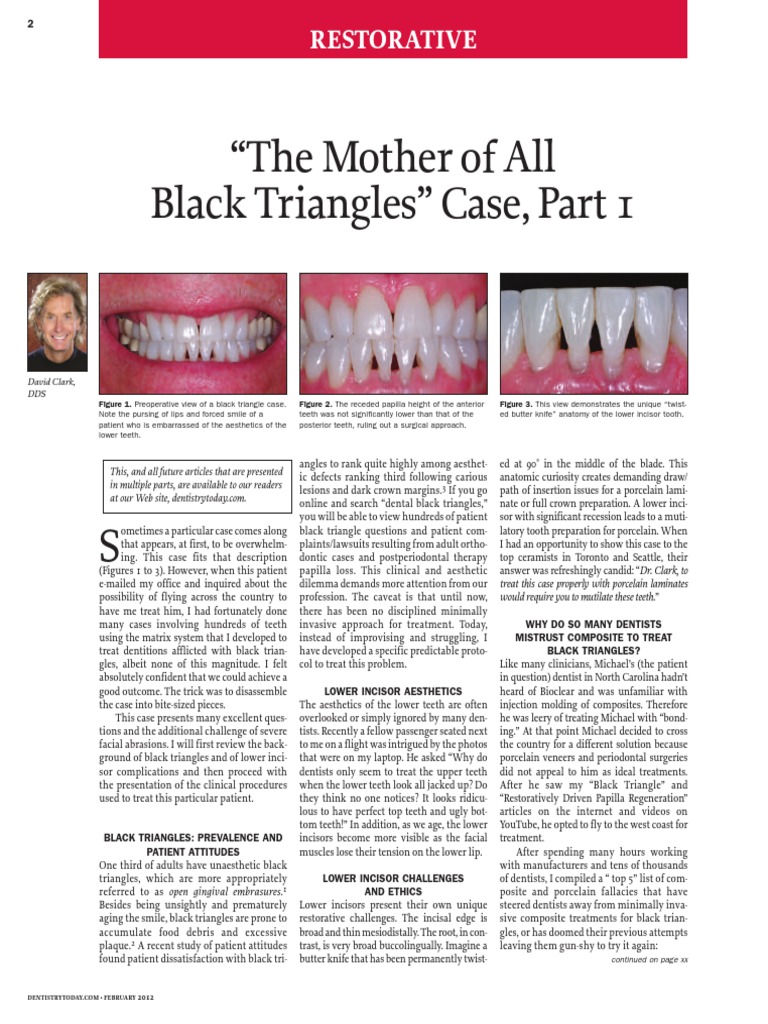 Treating the Mother of Black Triangles with Bioclear Veneers | Tooth ...