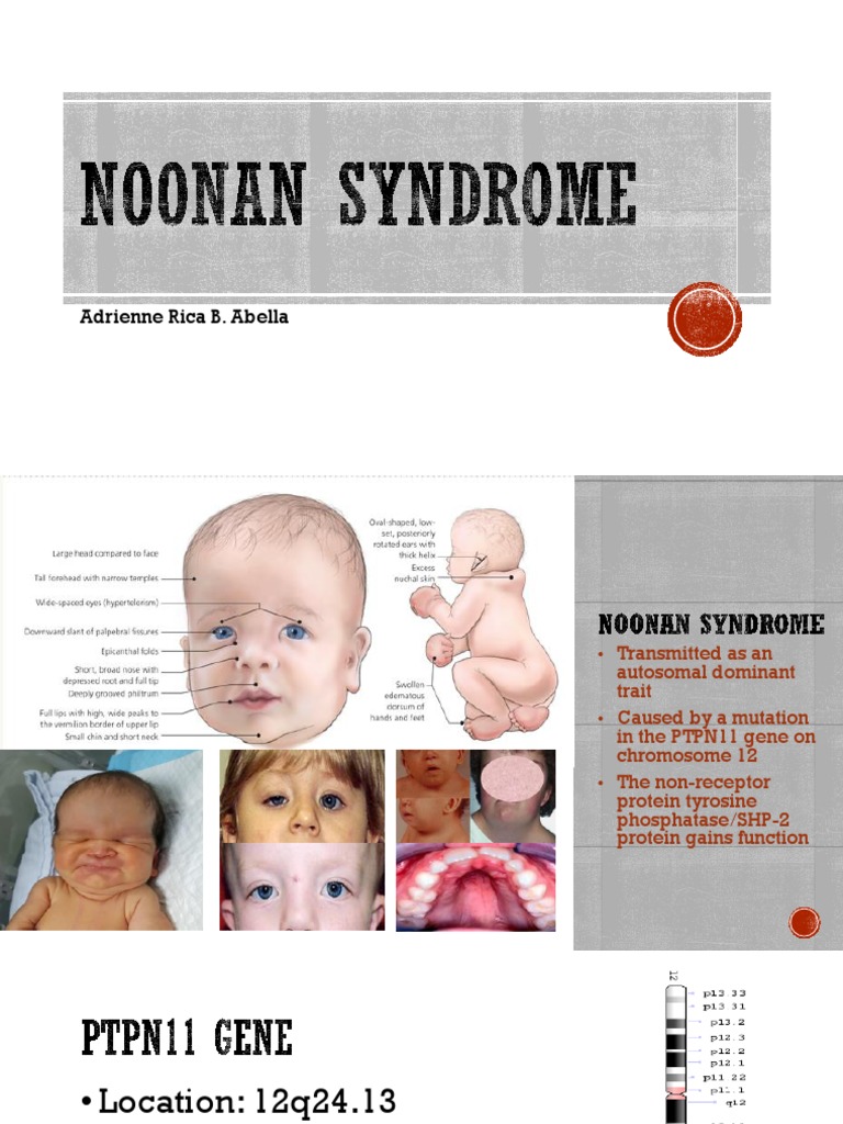 1 Noonan Syndrome | PDF