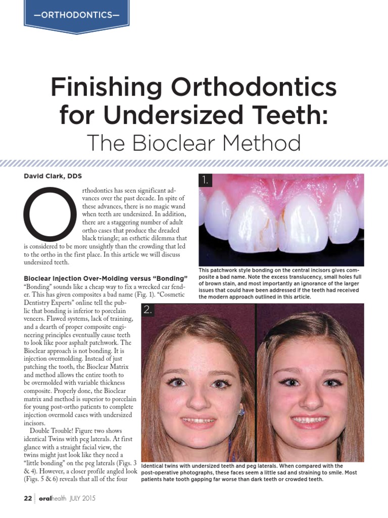 Orthodontics For Undersized Teeth: The Bioclear Method | PDF | Orthodontics | Tooth
