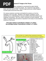 Pneumothorax Size Measurement Methods | PDF | Medicine | Clinical Medicine