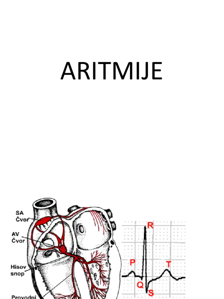 Aritmije | PDF
