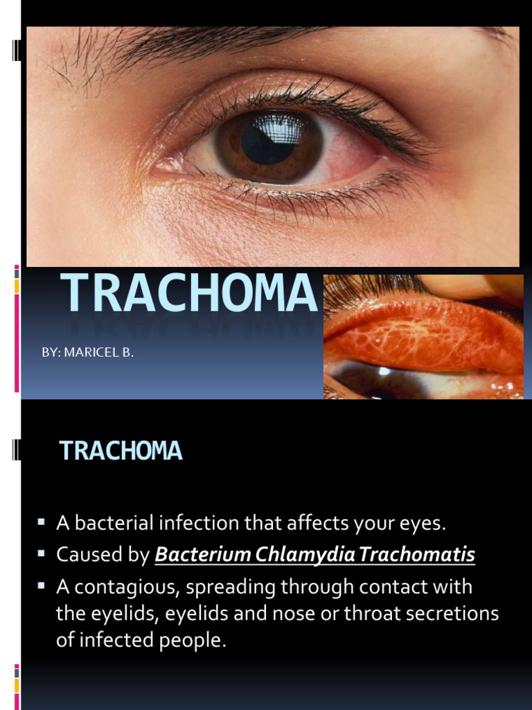 Trachoma | PDF