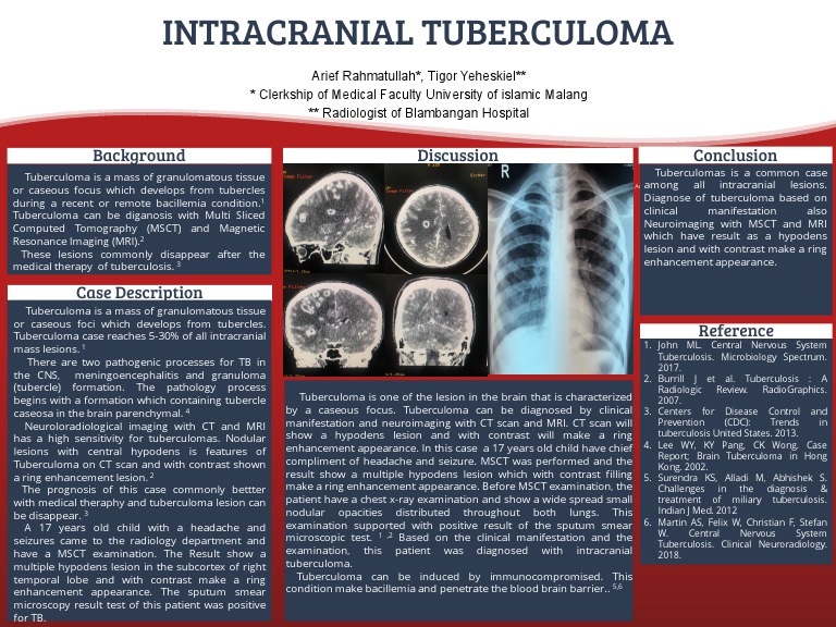 Intracranial Tuberculoma 5 | PDF | Ct Scan | Magnetic Resonance Imaging