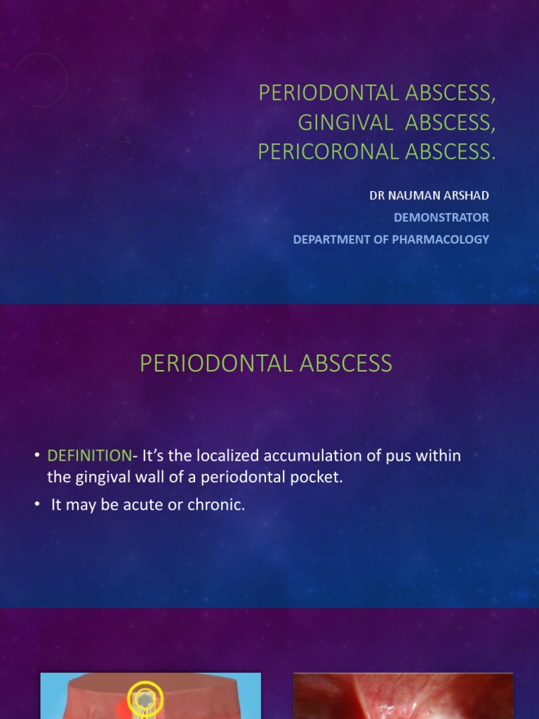 Periodontal Abscess and Periodontal Dressings | PDF | Periodontology ...