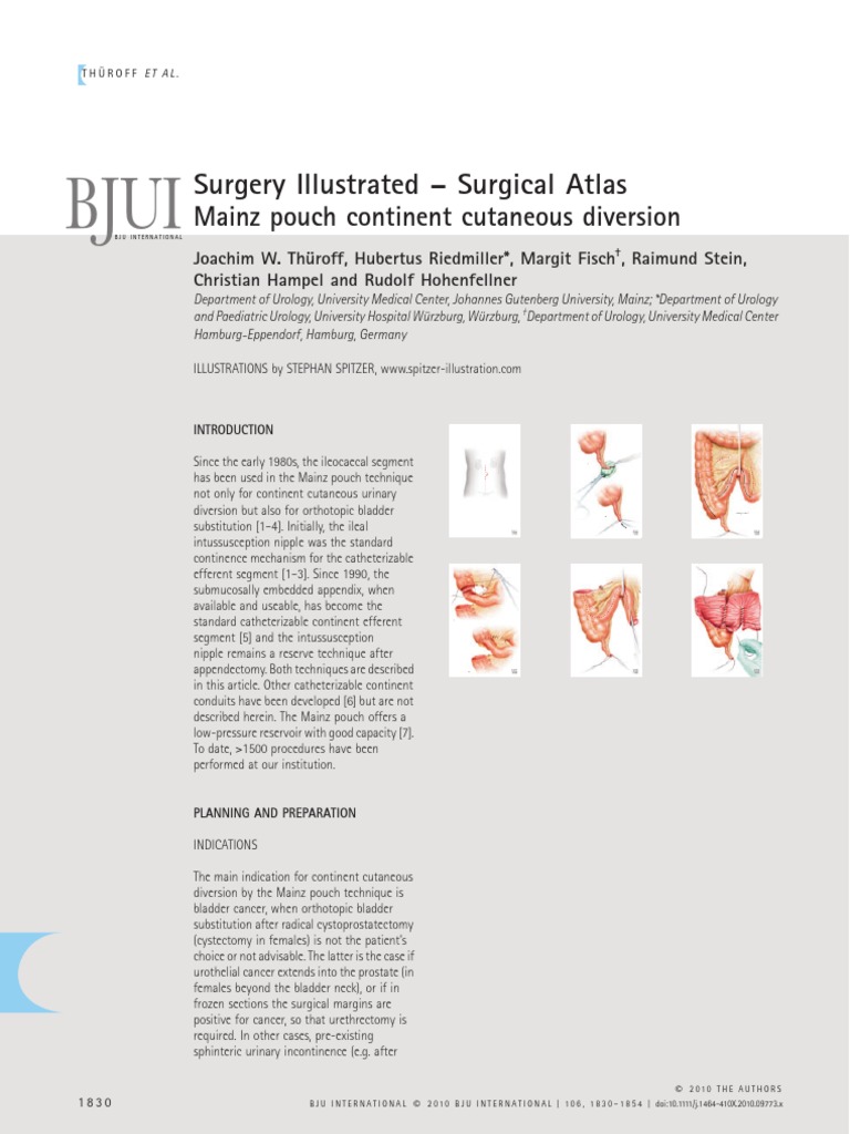 Surgery Illustrated - Surgical Atlas: Mainz Pouch Continent Cutaneous ...