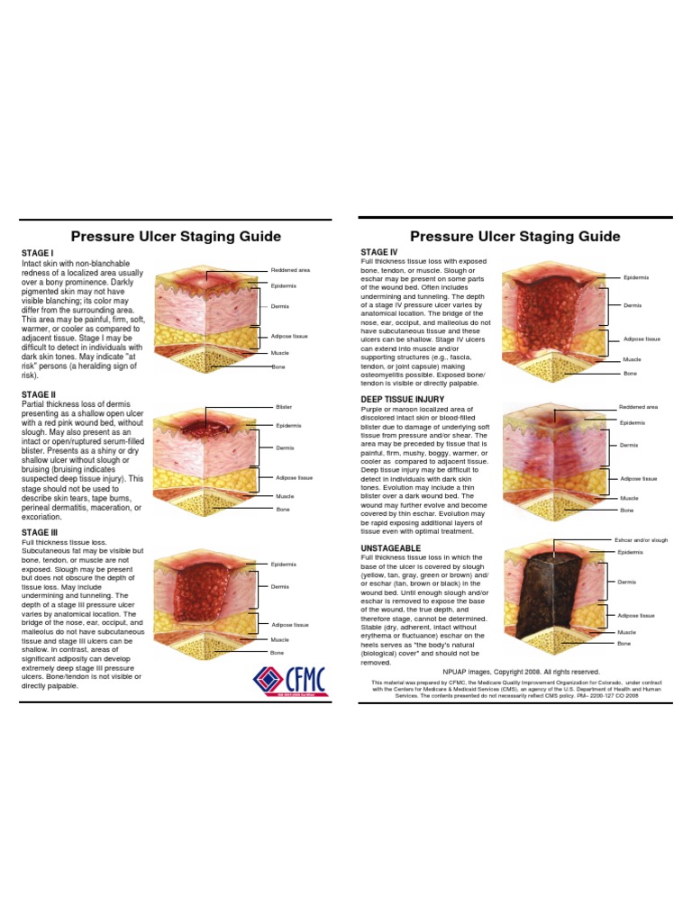 Pressure Ulcer Staging Guide