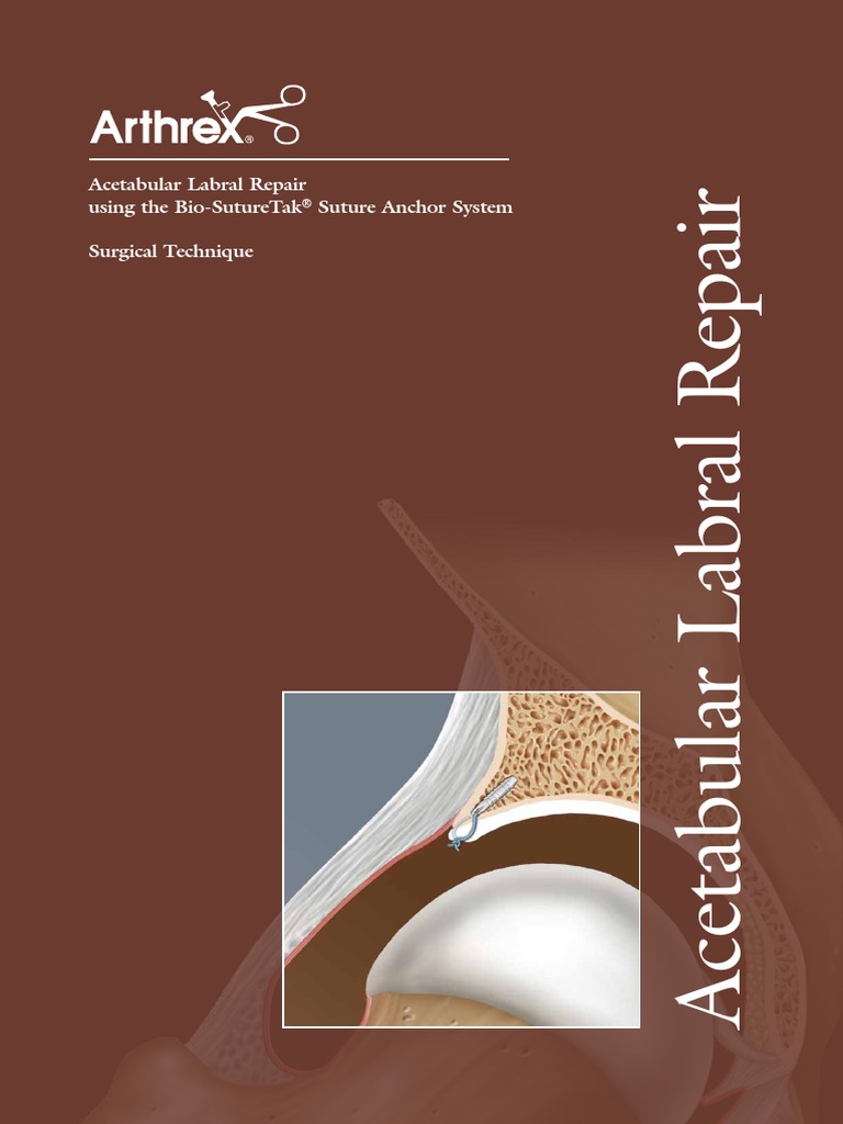 Acetabular Labral Repair Using The Bio SutureTak Suture Anchor System ...