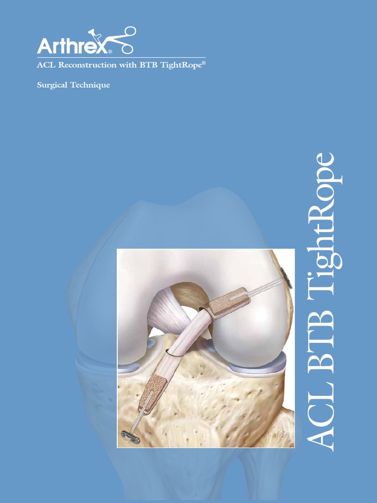 ACL Reconstruction With BTB TightRope | PDF | Surgical Suture | Bone