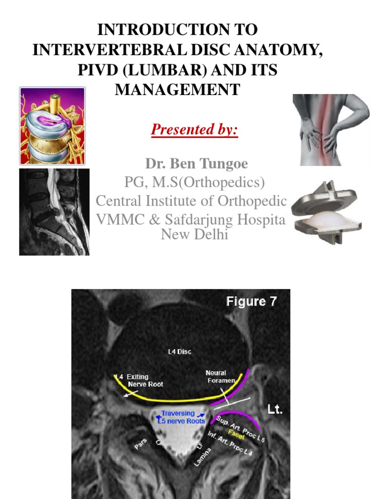 Introduction To Intervertebral Disc Anatomy, Pivd (Lumbar) and Its ...
