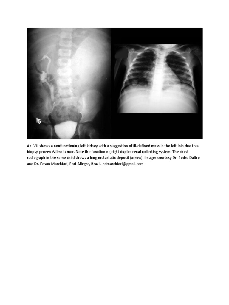 Bno Ivp Nephroblastoma | PDF | Social Science | Wellness