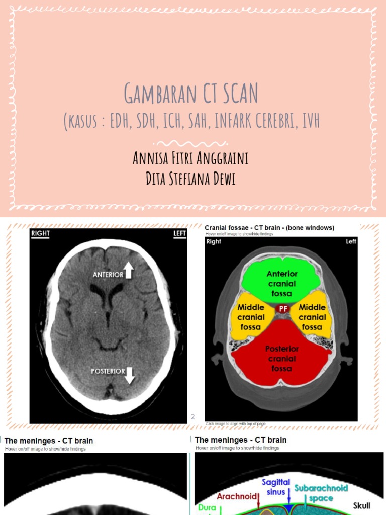 Gambaran CT SCAN: (Kasus: Edh, SDH, Ich, Sah, Infark Cerebri, Ivh | PDF ...