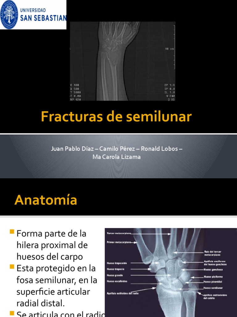 Fracturas y Tratamiento del Semilunar | PDF | Enfermedades y trastornos ...