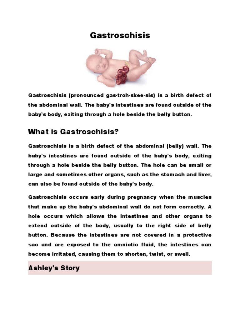 An In-Depth Look at Gastroschisis: Causes, Symptoms, Diagnosis and ...