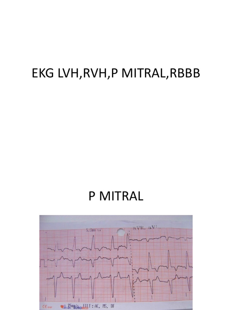 Ekg LVH, RVH, P Mitral, RBBB | PDF