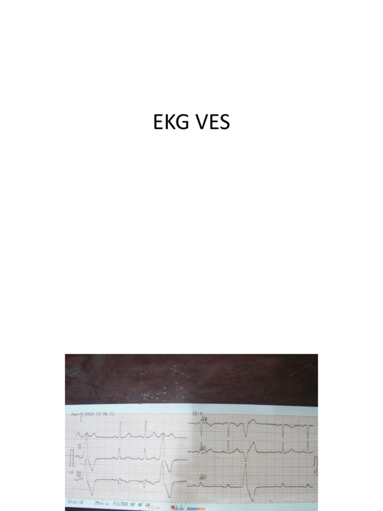 Ekg Ves | PDF