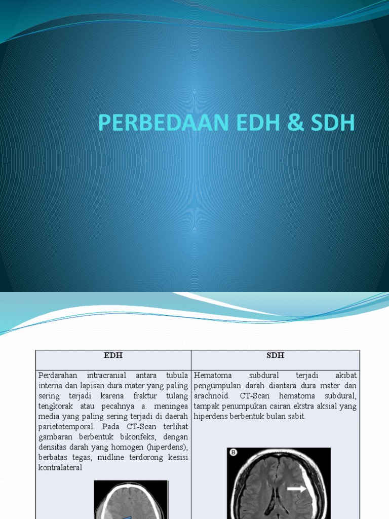 Perbedaan SDH & Edh | PDF