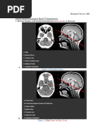 CT Brain Interpretation Guide | PDF | Stroke | Cerebrospinal Fluid
