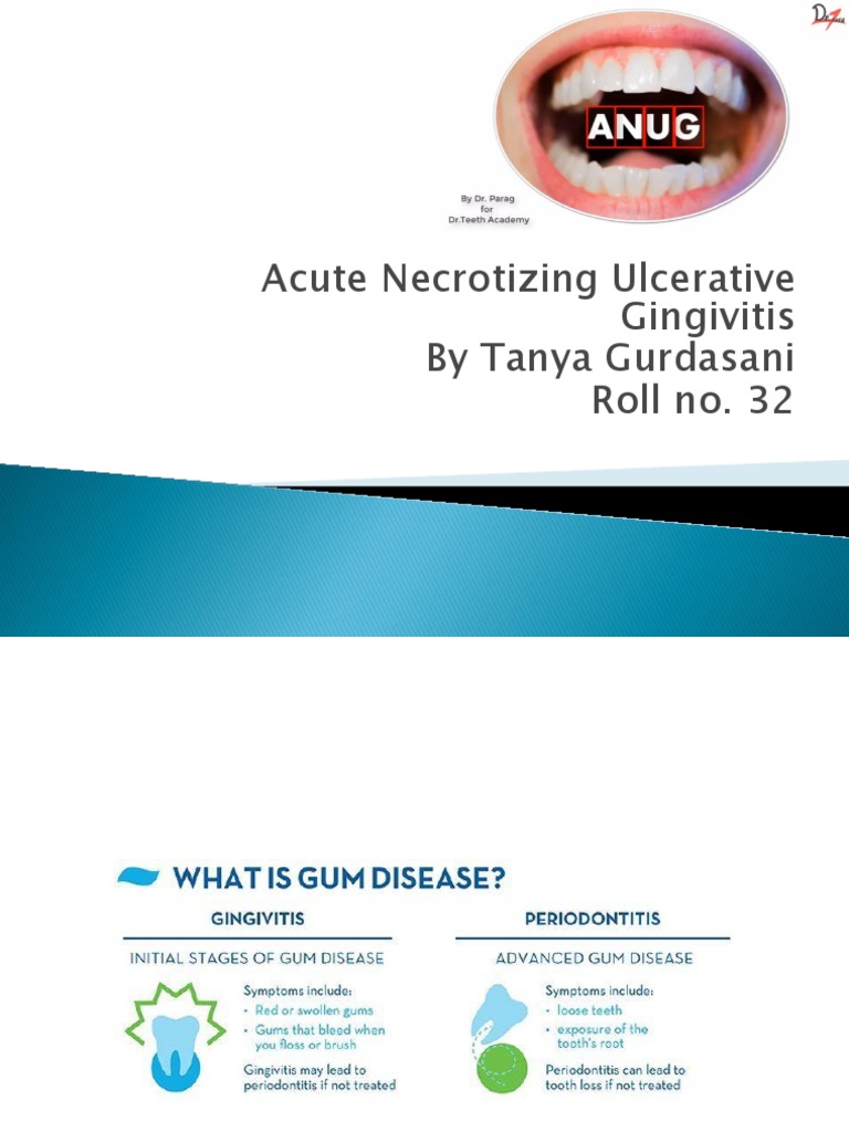 An Overview of Acute Necrotizing Ulcerative Gingivitis: Causes ...