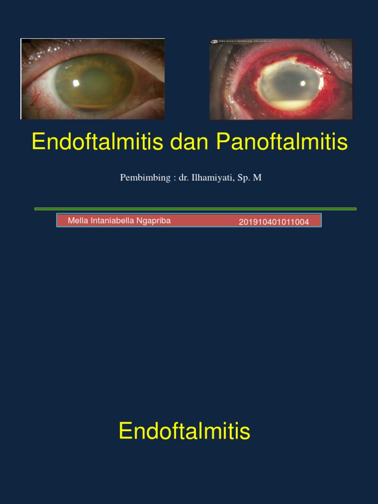 Endoftalmitis dan Panoftalmitis: Etiologi, Patofisiologi, Manifestasi Klinis, Diagnosis, dan ...