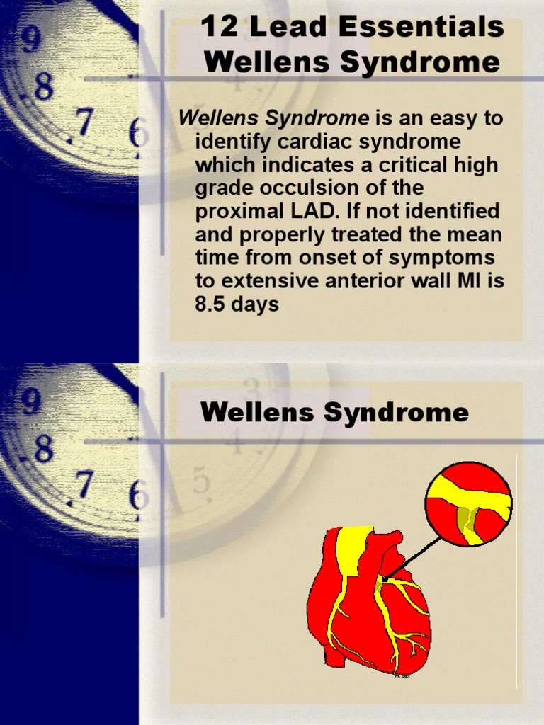 Wellens Syndrome: Identification and Management | PDF