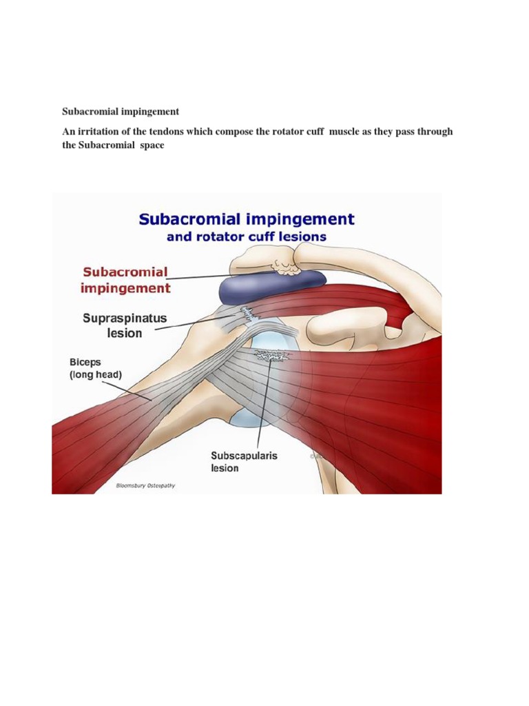 Subacromial Impingement An Irritation of The Tendons Which Compose The ...