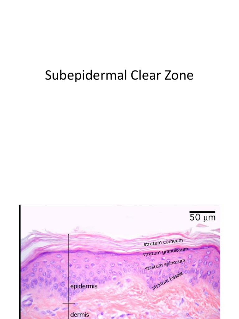 Subepidermal Clear Zone | PDF