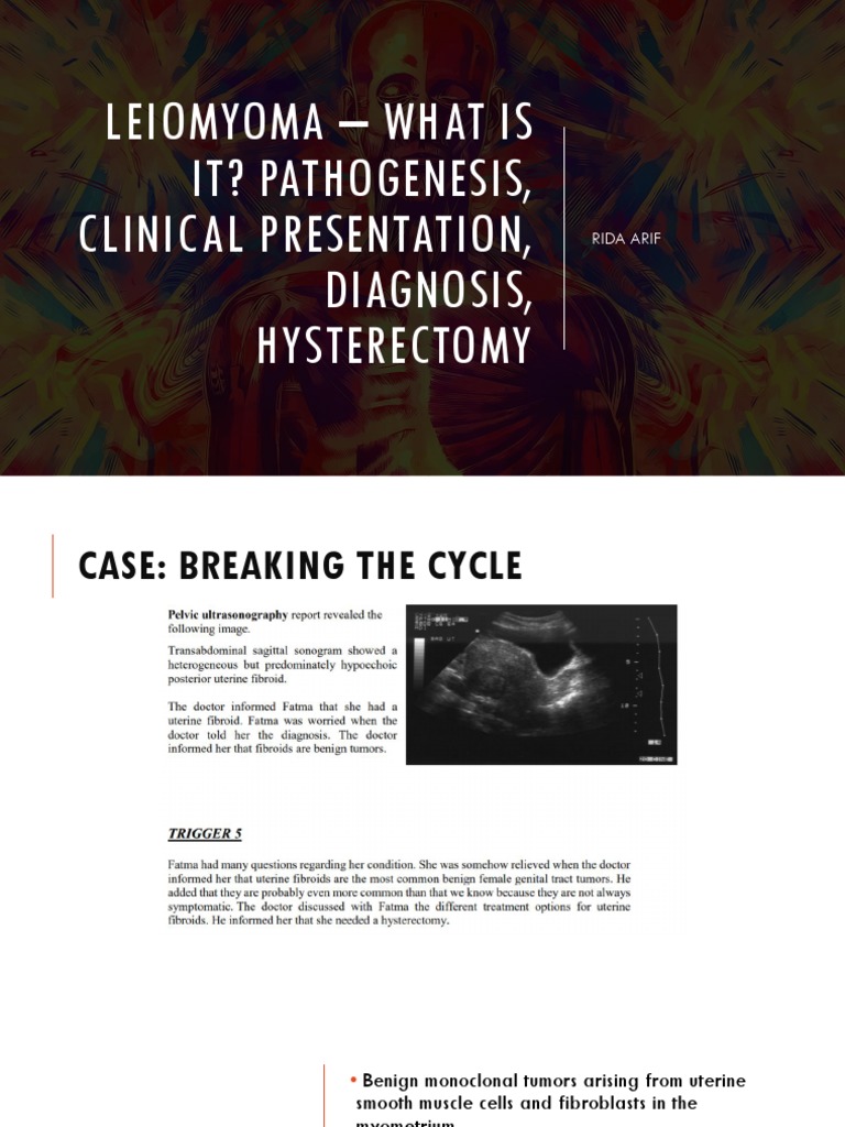 Leiomyoma - What Is It? Pathogenesis, Clinical Presentation, Diagnosis ...