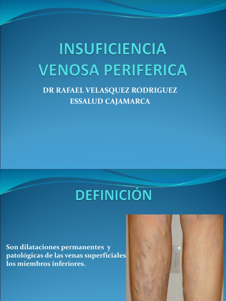 Varices | PDF | Venas varicosas | Pie