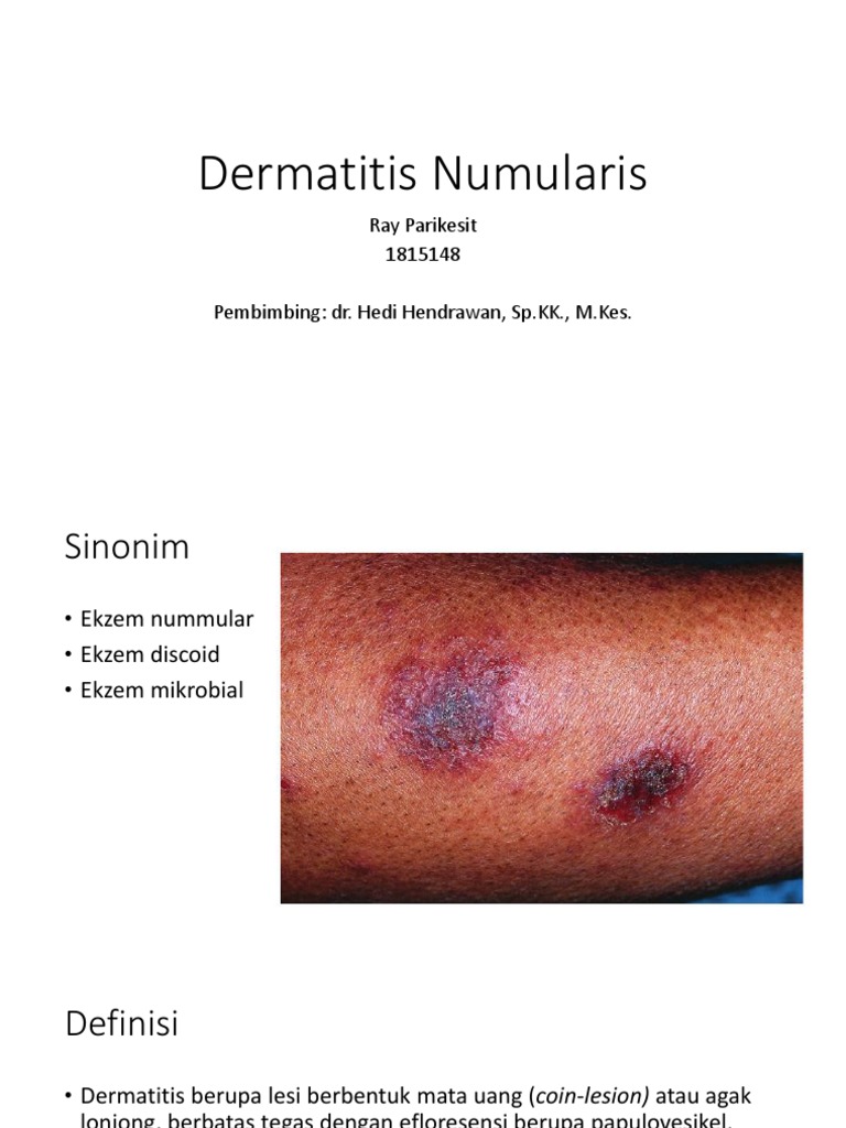 Dermatitis Numularis | PDF
