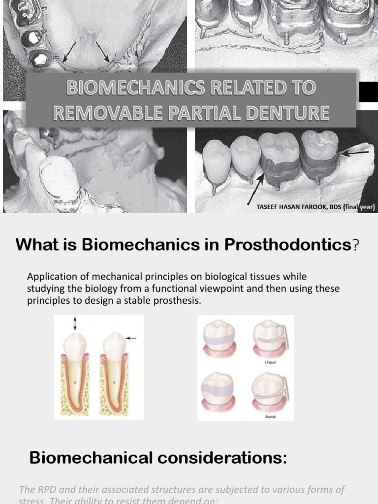 Biomechanics in Removable Partial Denture | PDF | Lever | Dentures
