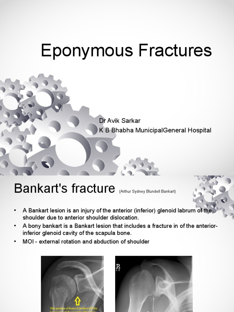 Eponymous Fractures: DR Avik Sarkar K B Bhabha Municipalgeneral ...