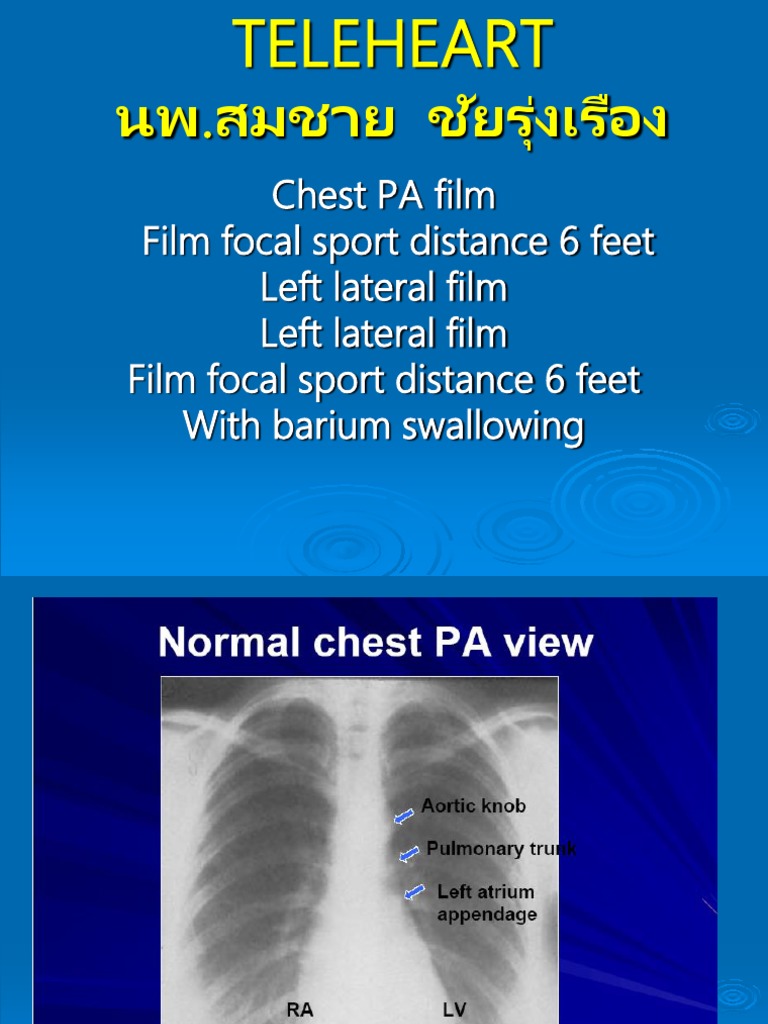 Chest PA Film Film Focal Sport Distance 6 Feet Left Lateral Film Left ...