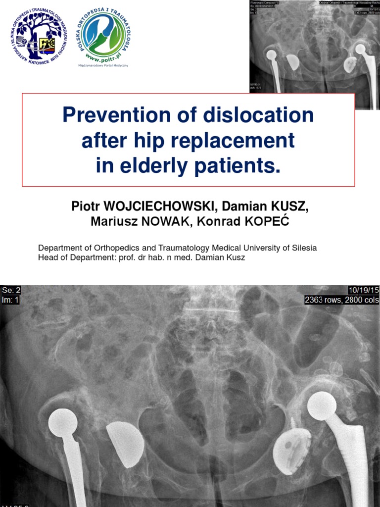 Prevention of Dislocation After Hip Replacement in Elderly Patients ...