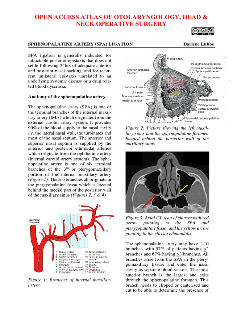 Sphenopalatine Artery - SPA - Ligation | PDF | Human Nose | Human Head ...
