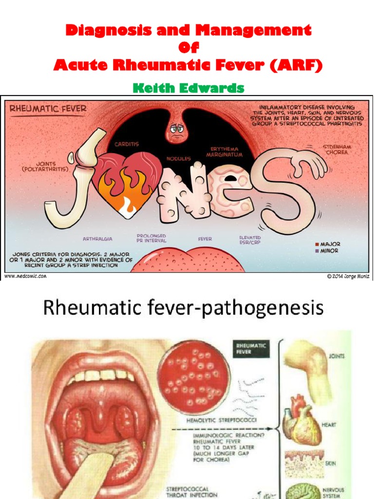 Acute Rheumatic Fever Diagnosis and Management - Rhda Workshop March ...