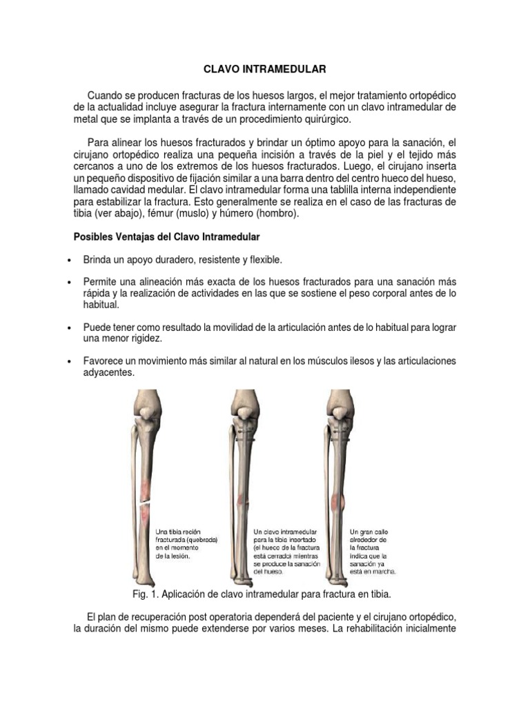 Tratamiento de fracturas óseas mediante clavos intramedulares ...