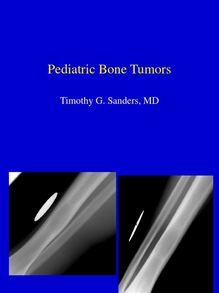 Radiology Pediatric Bone Tumors | PDF | Bone | Musculoskeletal Disorders