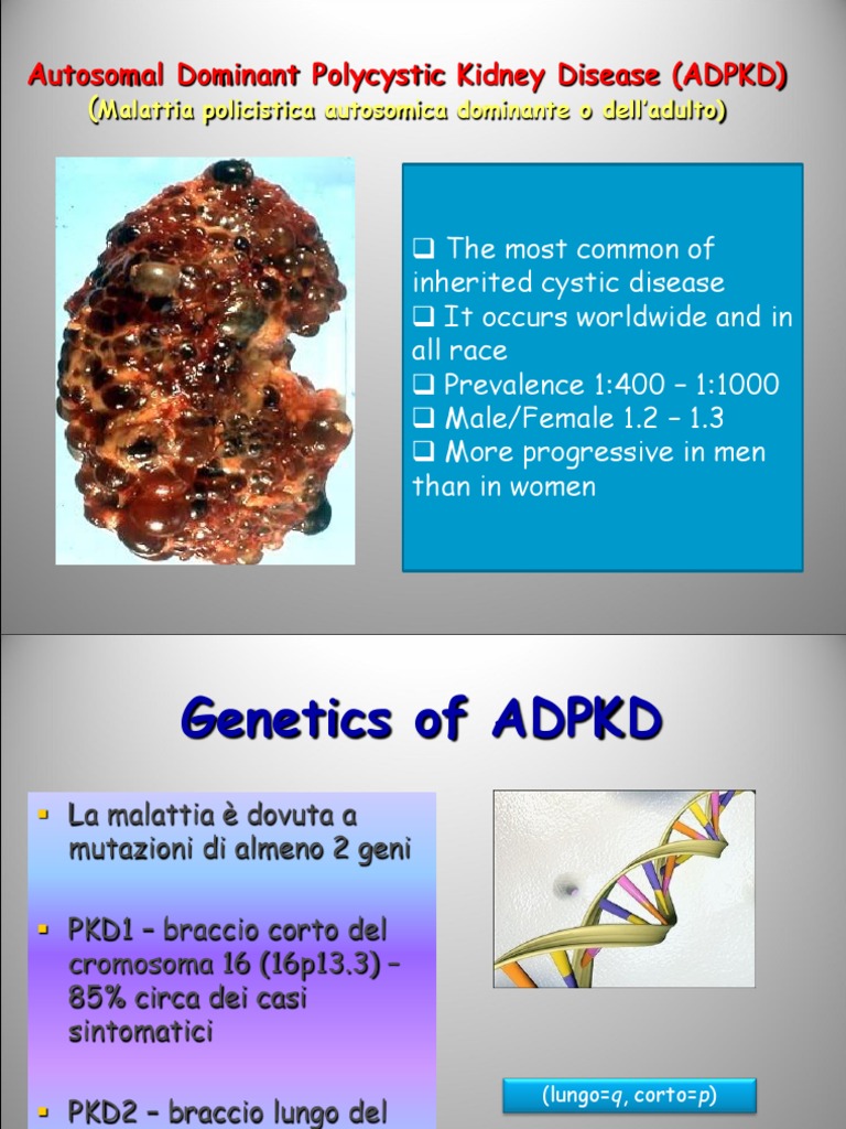 Autosomal Dominant Polycystic Kidney Disease (ADPKD) | PDF | Medical ...