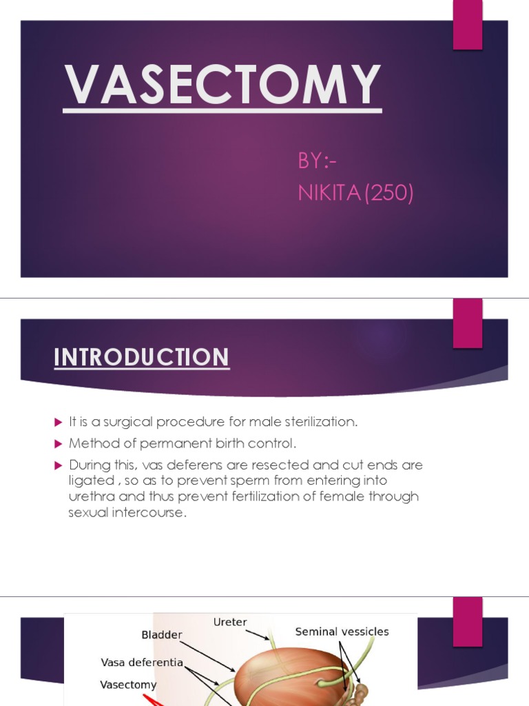 Vasectomy: BY:-NIKITA | PDF