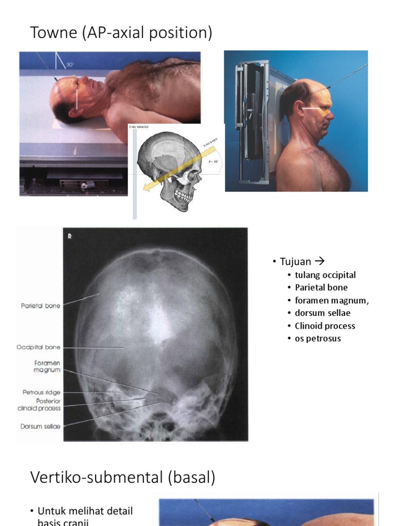 Towne Method for Skull Imaging | PDF