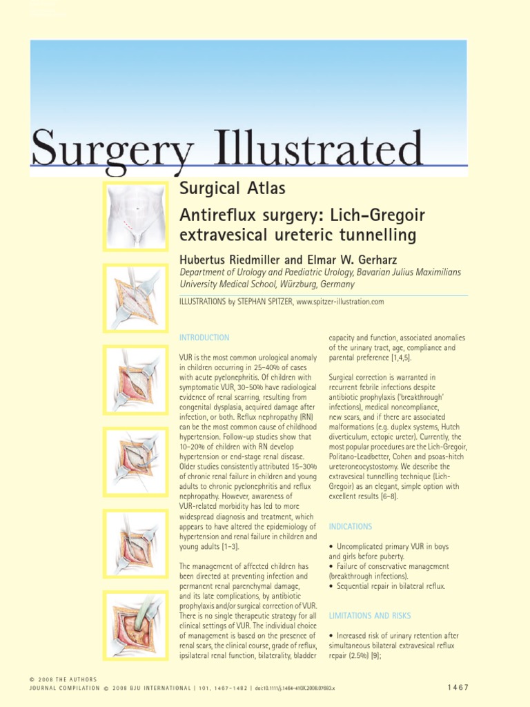 Antireflux Surgery Lich-Gregoir | PDF | Urinary Bladder | Abdomen