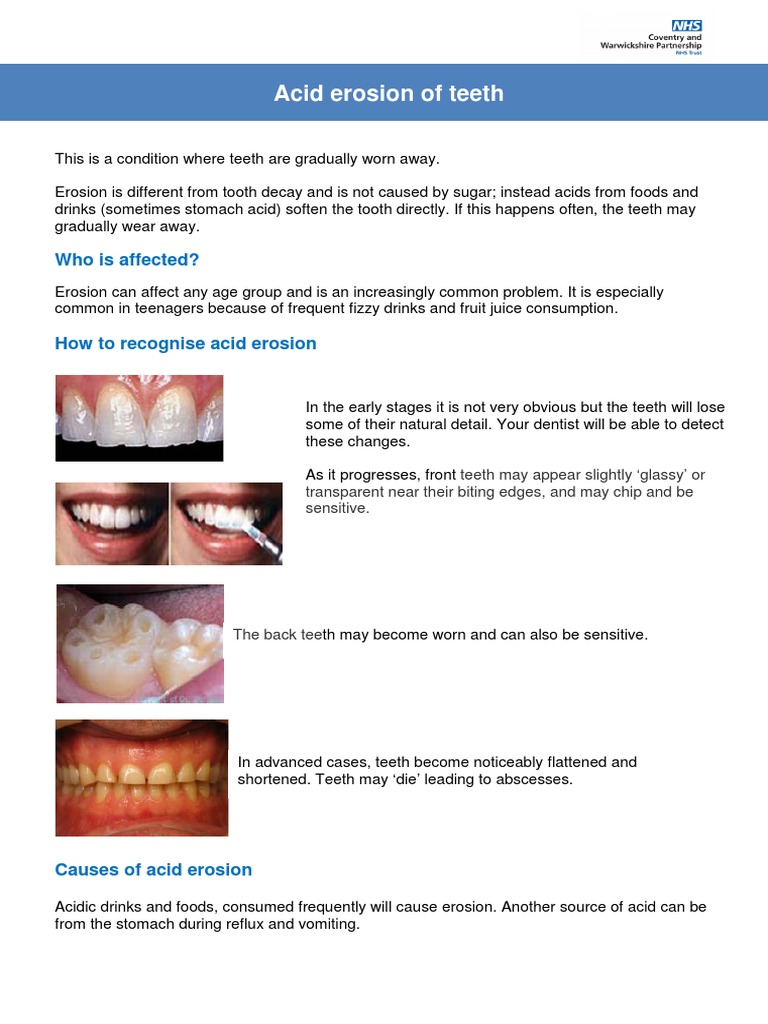 Acid Vs Teeth | PDF | Human Tooth | Dentistry