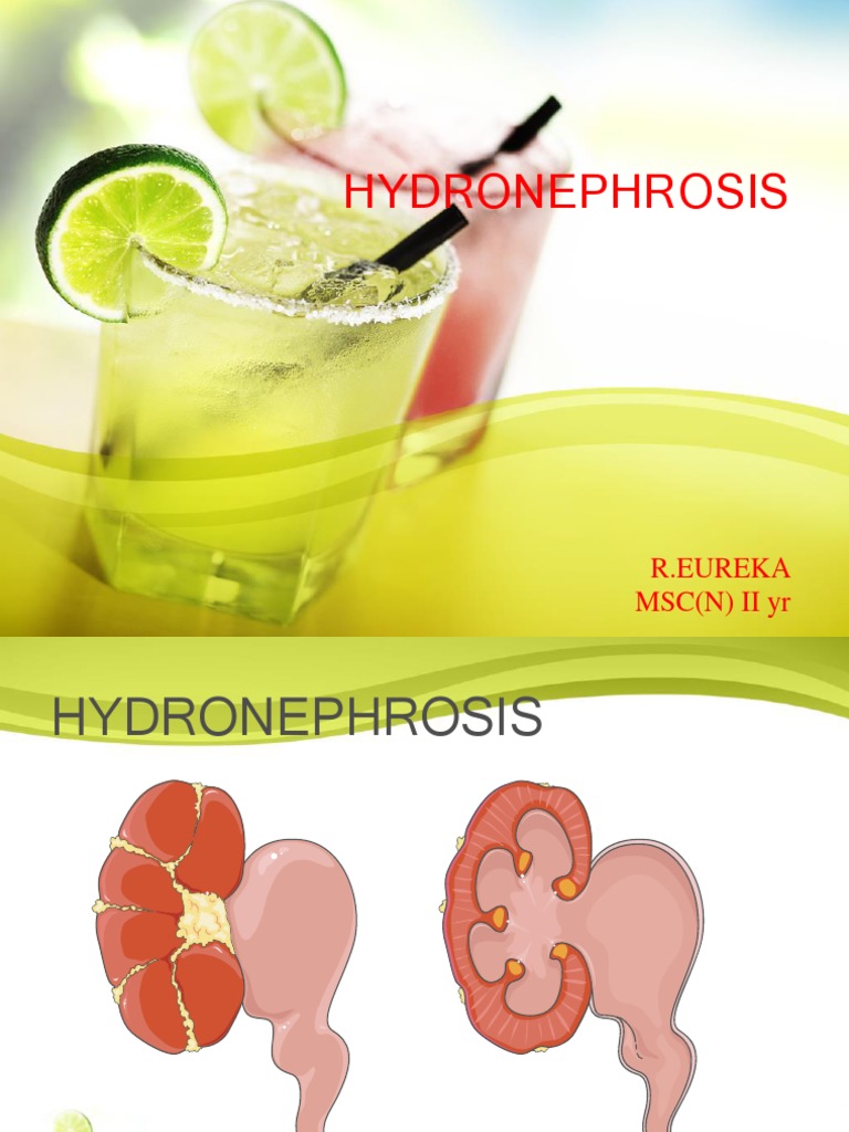 Understanding Hydronephrosis: Causes & Treatment | PDF | Urology ...