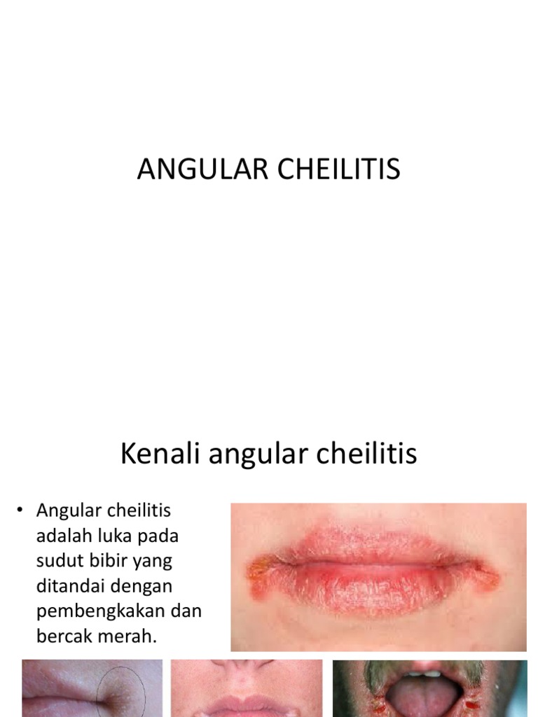 Angular Cheilitis | PDF