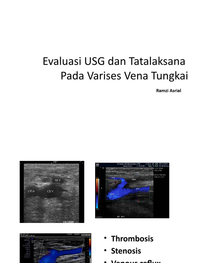 Evaluasi Usg Dan Tatalaksana Pada Varises Vena Tungkai - DR Ramzi | PDF ...