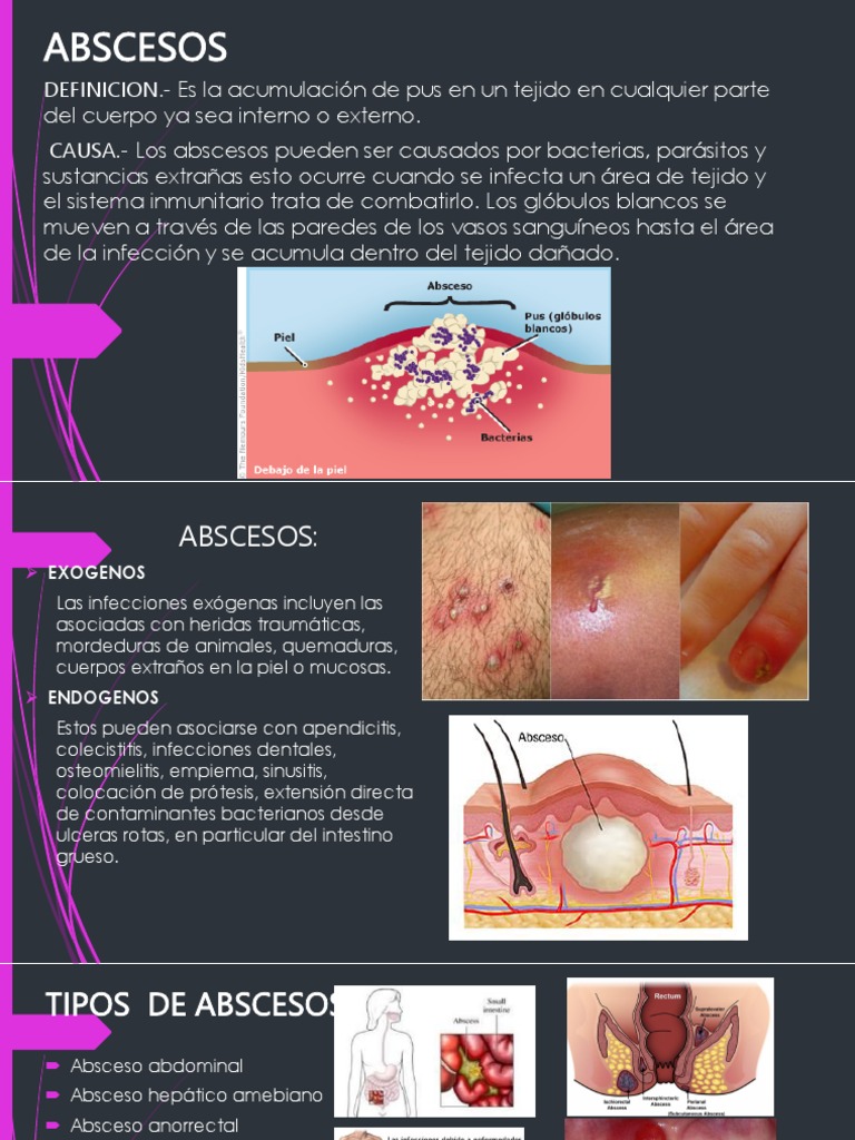 ABSCESOS | PDF | Estreptococo | Staphylococcus Aureus