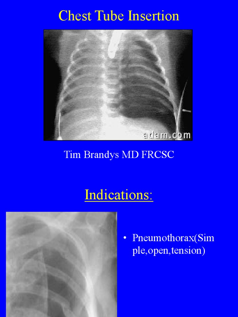 Chest Tube Insertion Core | PDF