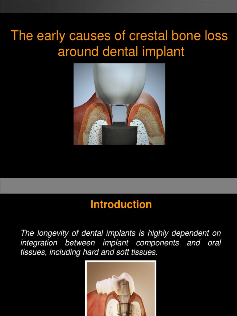The early causes of crestal bone loss around dental implant | Dental ...