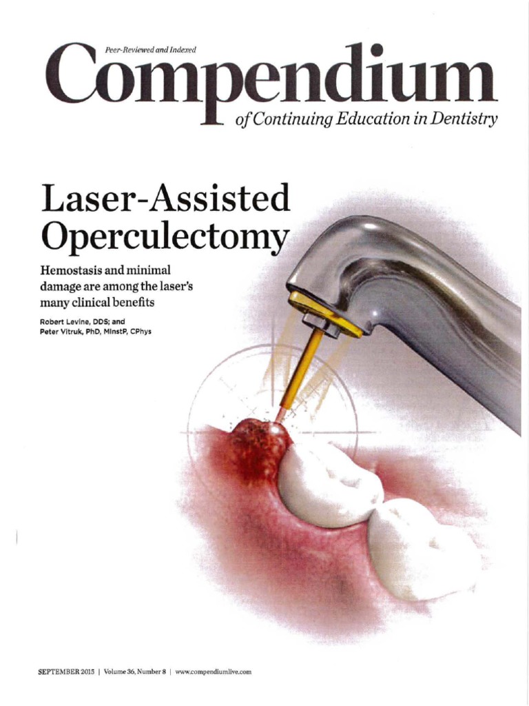 Laser Assisted Operculectomy Hemostasis and Minimal Damage Are Among ...