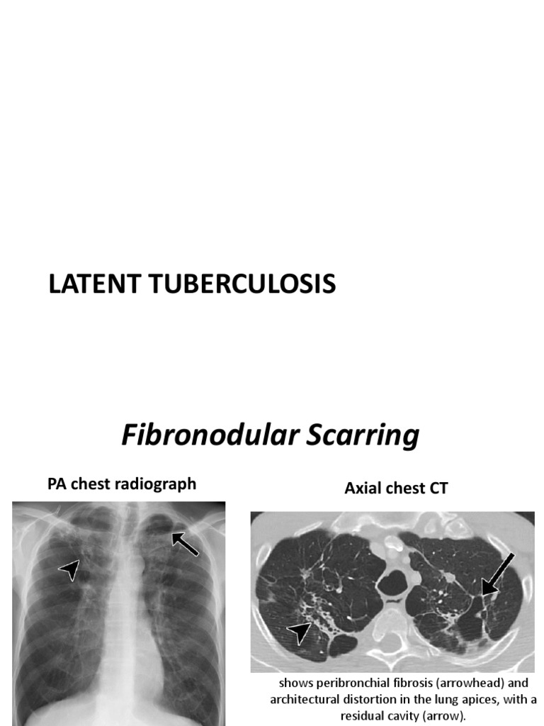 TB Radiology | PDF | Tuberculosis | Health Sciences